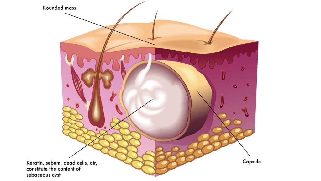 Sebaceous Cyst Removal Excision Gold Coast Skin Clinic Robina Sebaceous Cyst Removal Excision Gold Coast Skin Clinic Robina