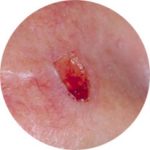 Basal Cell Carcinoma (BCC) - Cancer | Skin Clinic Robina