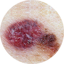 Melanoma Treatment - Skin Cancer Surgery | Skin Clinic Robina