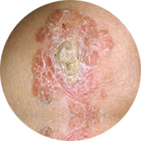 Squamous Cell Carcinoma (BCC) - Cancer | Skin Clinic Robina