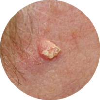Squamous Cell Carcinoma (BCC) - Cancer | Skin Clinic Robina