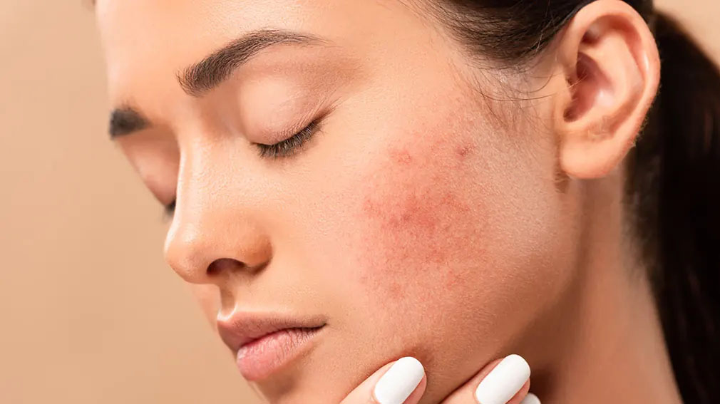 Acne: Causes, Symptoms & Clinical Treatments Available